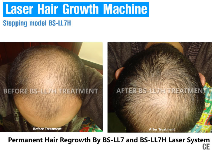 400 Diode Laser Hair Regrowth System - Diode Laser Hair Regrowth, Laser Hair Therapy, Male ...